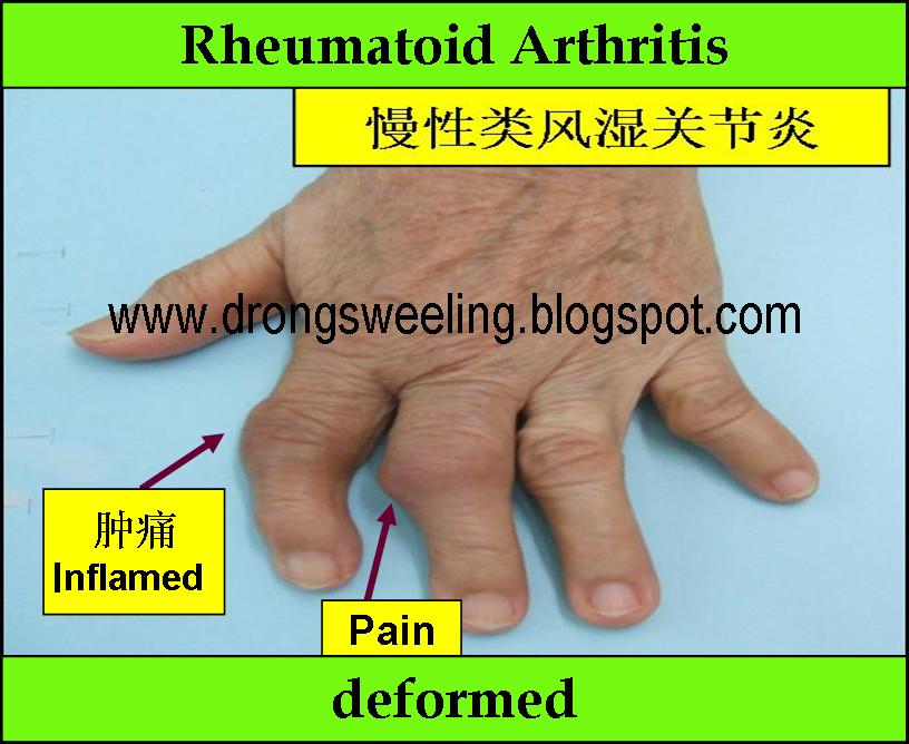 TCM News: Best TCM Clinic For Rheumatoid Arthritis Osteoarthritis ...