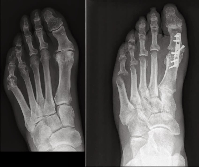 Fanáticos del pie: ATLAS DE PATOLOGÍA DEL PIE: ANTEPIE REUMATICO