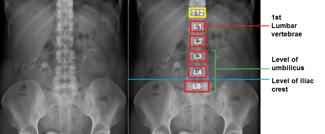 HS2135 Statistics Project - Can the umbilicus be a good indicator of ...