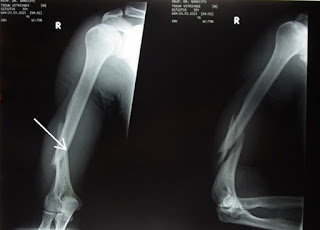 Orthopaedi Knowledges: MANAGEMENT OF LONG BONE FRACTURES