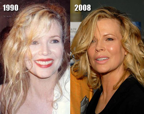 Kim Basinger Plastic Surgery