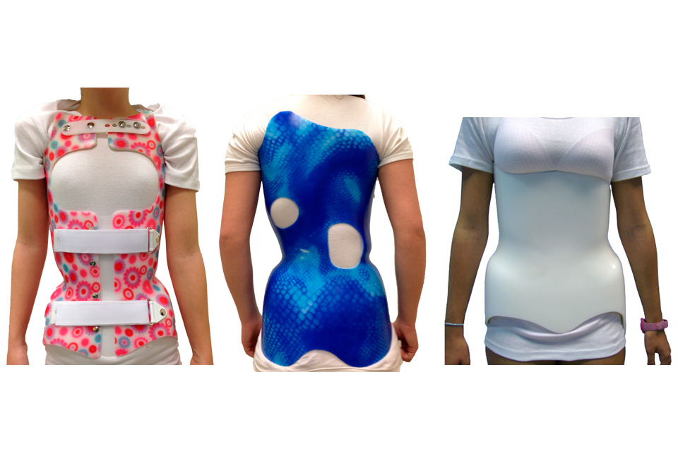 ENFERMERÍA EN TRAUMATOLOGÍA Y ORTOPEDIA: CORSET ORTOPÉDICO