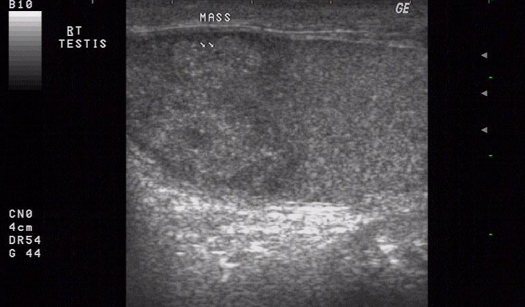 SONO DIGEST: SEGMENTAL TESTICULAR INFARCT