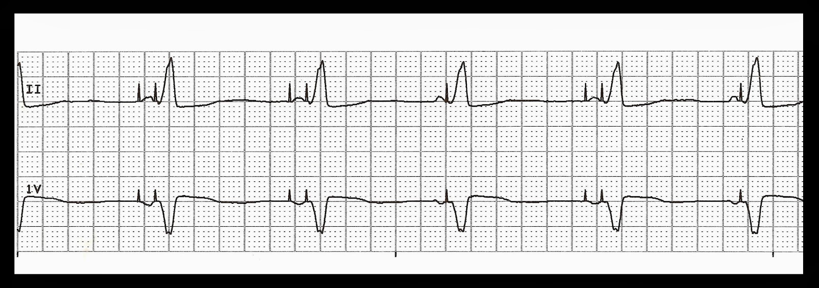 Various Dual Paced Rhythms