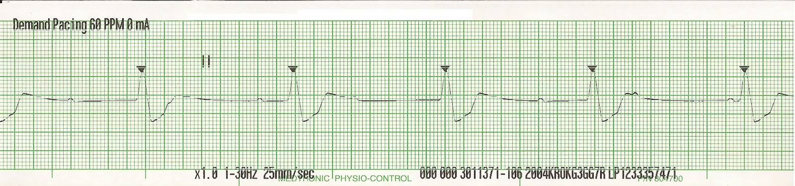 Pediatric External Pacing