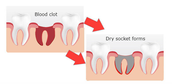 Ξηρό φατνίο Μία δυσάρεστη μετεγχειρητική οδοντιατρική επιπλοκή