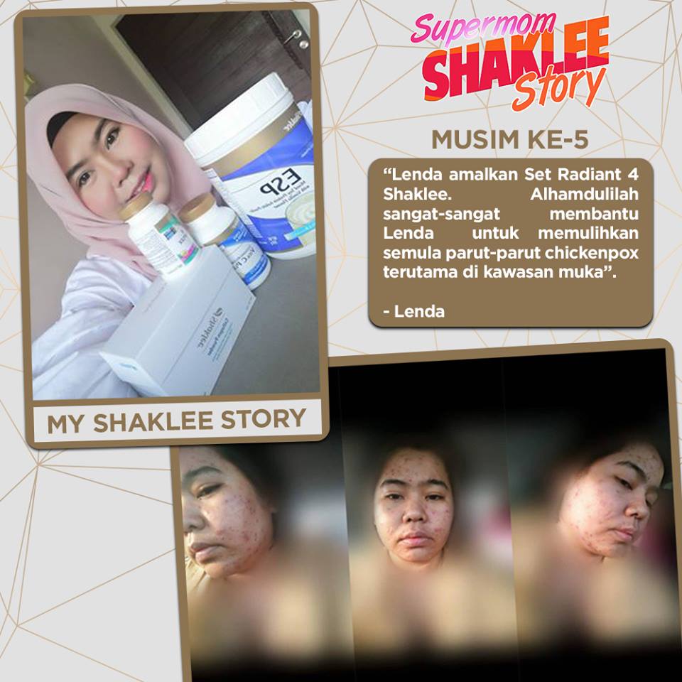 Cara Hilangkan Parut Chicken Pox Di Wajah Dengan Cepat - Amizah Azid