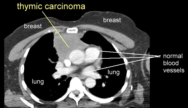 Chest Section: 9-1-2-Thymic tumors