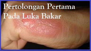 Definisi Luka Bakar (Combustio), Derajat Luka, Dan Cara Penanganannya ...