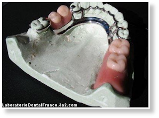 Conectores mayores en protesis parcial removible