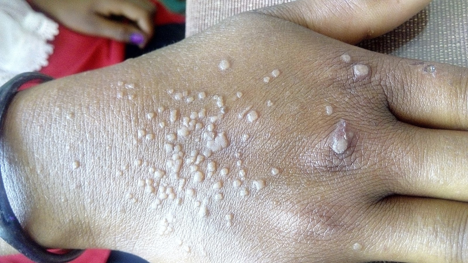 Treat Warts With Homeopathy-Sure And For Forever « Use Homeopathy And ...