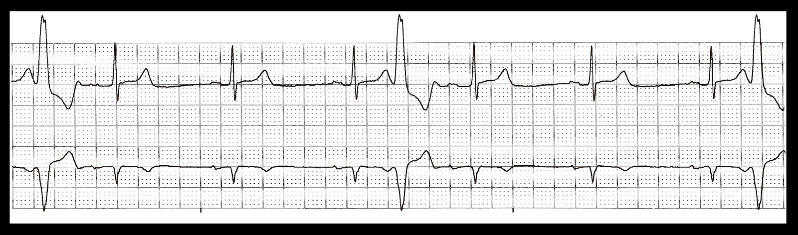 Various Quadrigeminal PVCs
