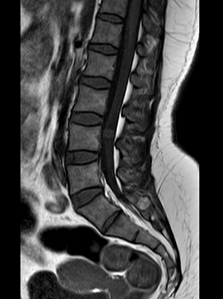 Cauda Equina Tumour-Differentials - Sumer's Radiology Blog