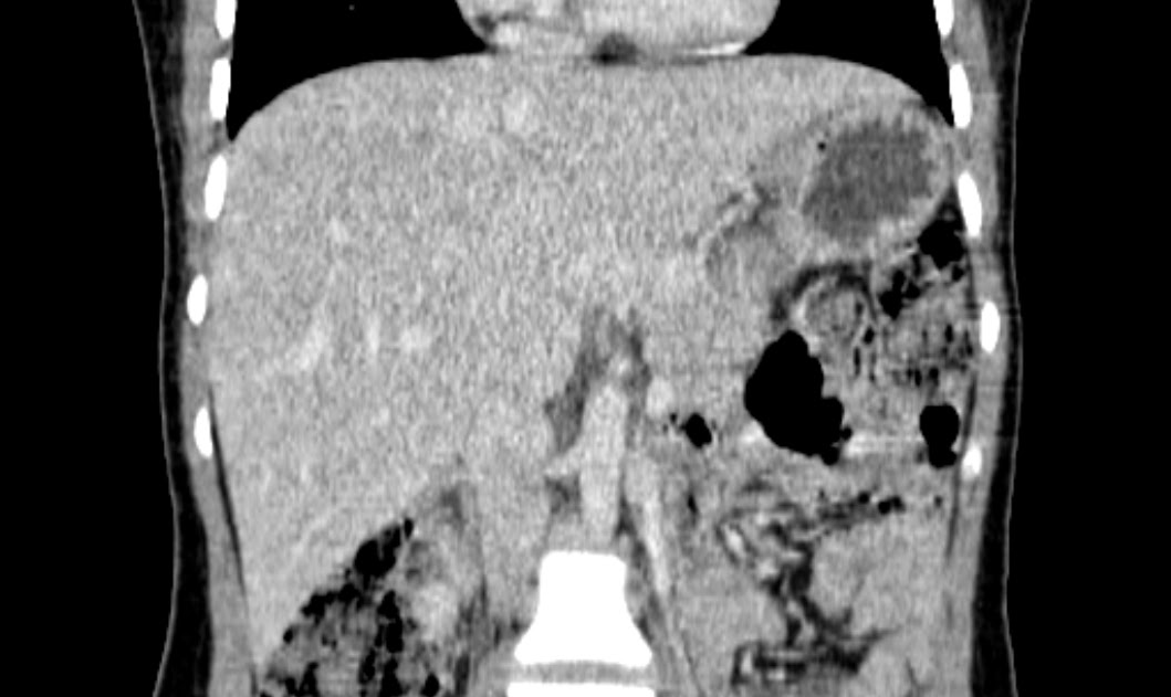 Ultimate Radiology : Pseudolesion : Papillary Process of Caudate Lobe