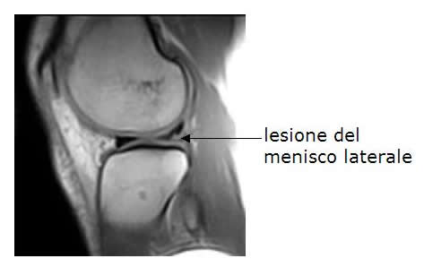 Le malattie "sorprese ": Lesioni meniscali - Ginocchio RMN lesione menisco