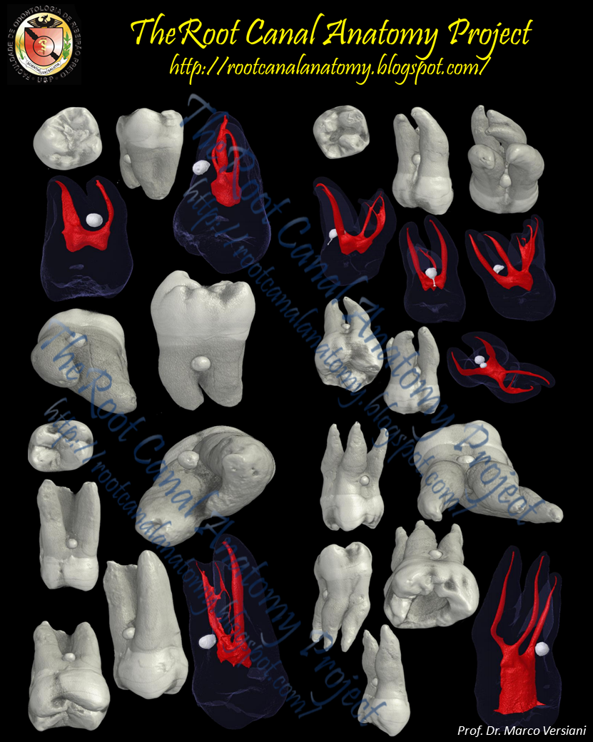 The Root Canal Anatomy Project: Enamel Pearls in Permanent Dentition
