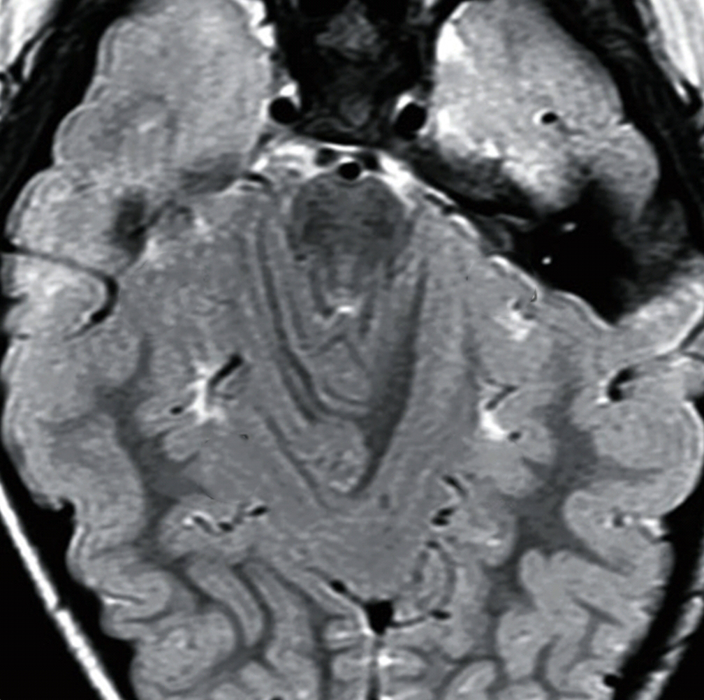 Chiari 2 malformation