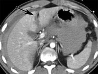 Abdominal Section: Peritoneal and omental sign 1:Sentinel clot sign