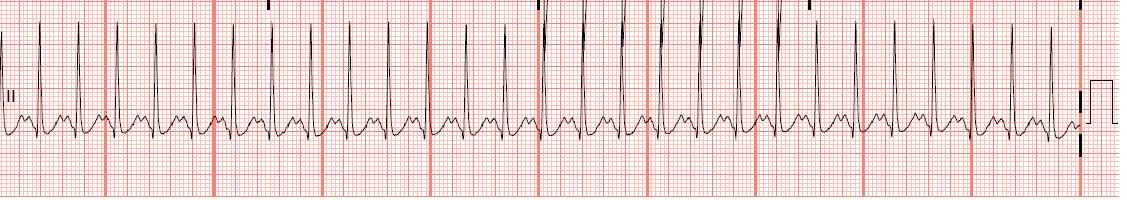 EKG Rhythm Strips 37