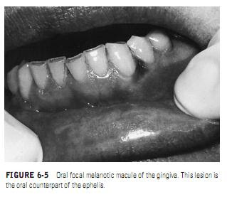 Burket’s Oral Medicine: Nevocellular Nevus and Blue Nevus