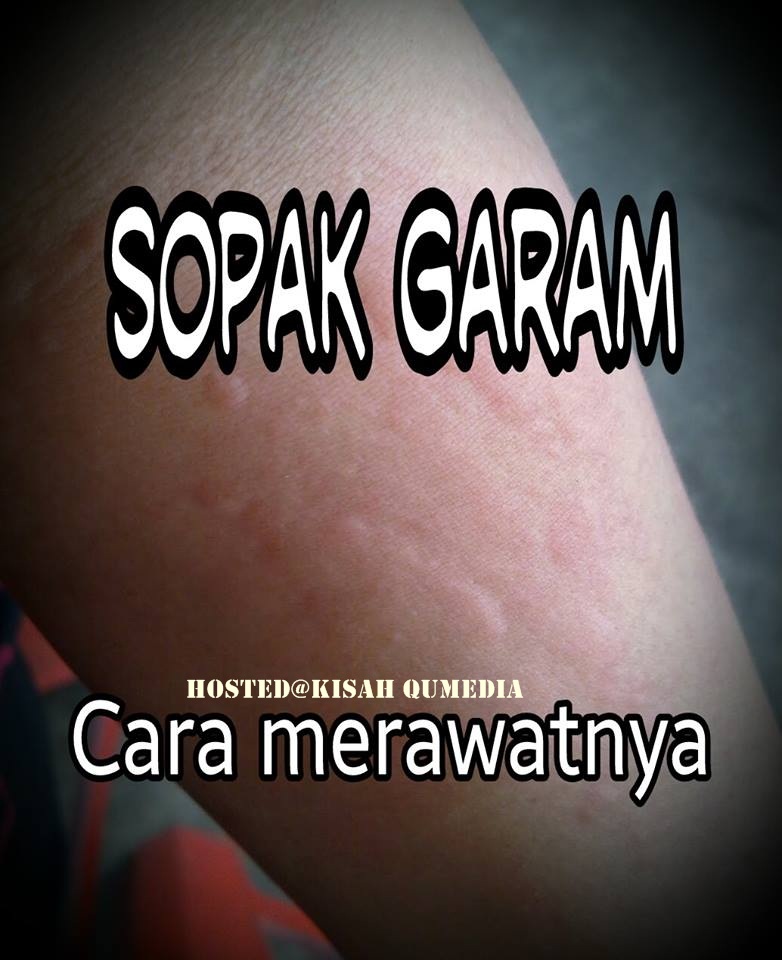 Sopak Garam @ Gegata...Penyakit Ludahan Jin Dan Cara Merawatnya