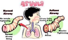 .: Cara Atasi Asma Kanak-Kanak Dengan Semulajadi