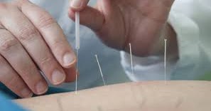 Chinese Medical: Acupuncture and pain relief