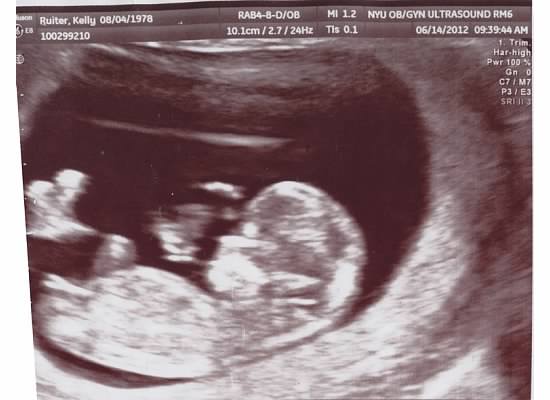 Easy Ryder: 1st NYU Ultrasound Scan (16 weeks)