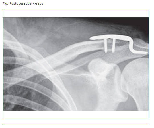 Shoulder and Elbow Surgery: "Shoulder Separation" or Collar bone ...