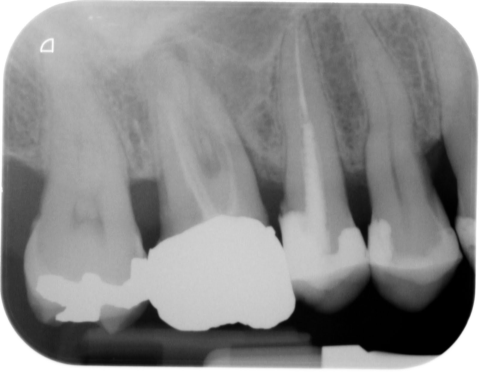 Instrumentación rotatoria Balear: Reendodoncia P 16