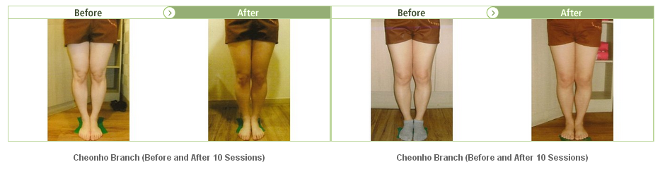 [Yakson house] before&after/pretty leg/ legs/ bowed leg/ beautiful leg