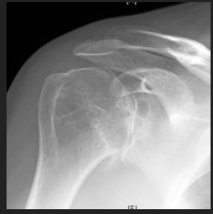 Shoulder Arthritis/Joint Replacement Rotator cuff tears: Changes ...