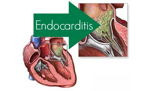 Que Es La Endocarditis Infecciosa: Síntomas, Causas Y Tratamiento