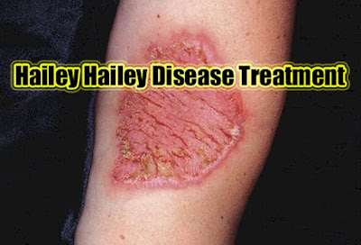 Hailey Hailey Disease Treatment - Natural Remedies And Treatment