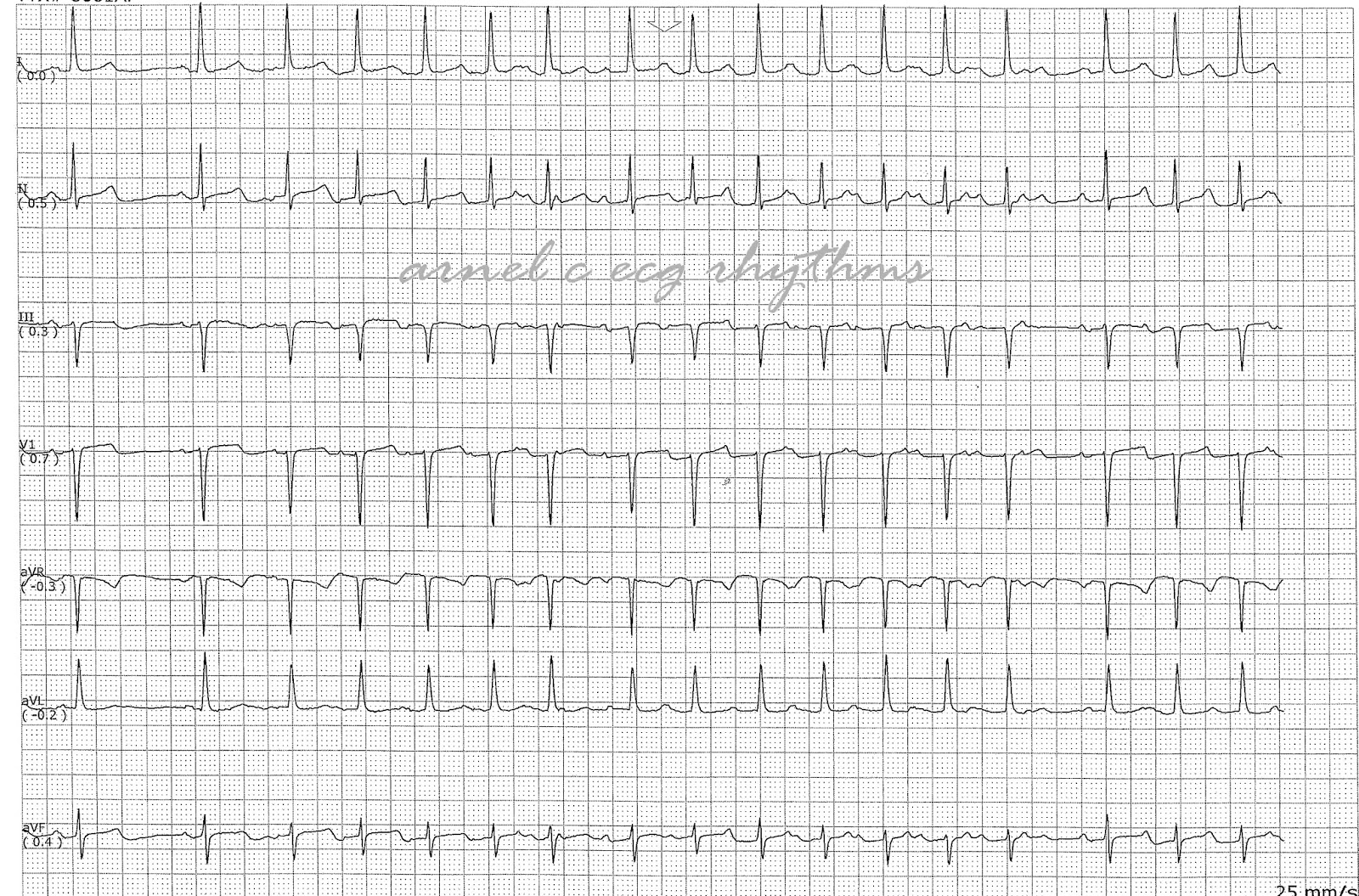 ECG Rhythms: Atrial Tachycardia with a Type I Block
