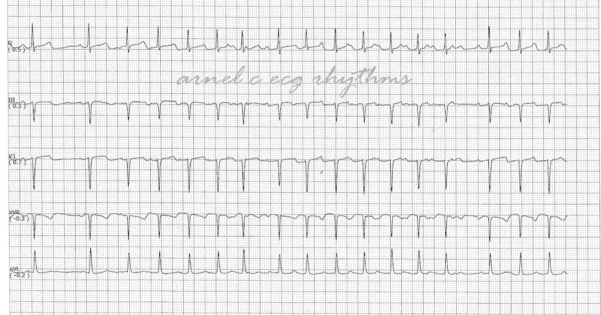 ECG Rhythms: Atrial Tachycardia with a Type I Block