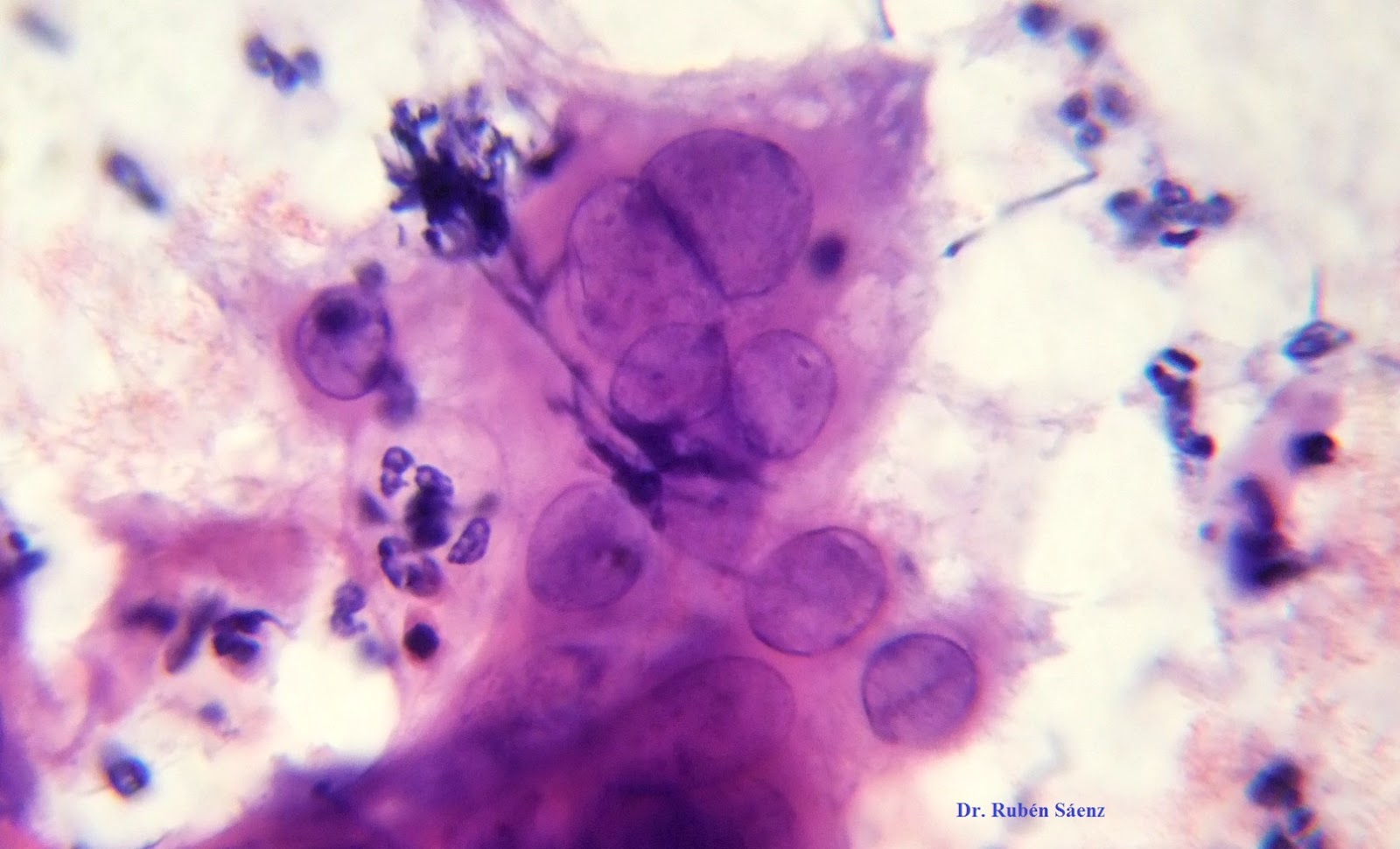 THE PERUVIAN CYTOPATHOLOGY CORNER: CITOLOGÍA CERVICAL: CAMBIOS POR HSV