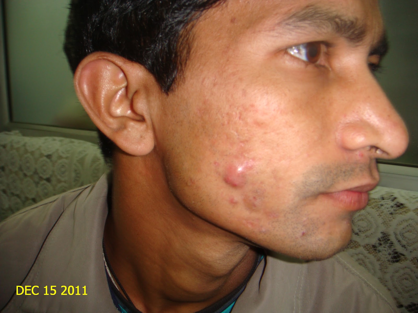 Acne Nodules On Face