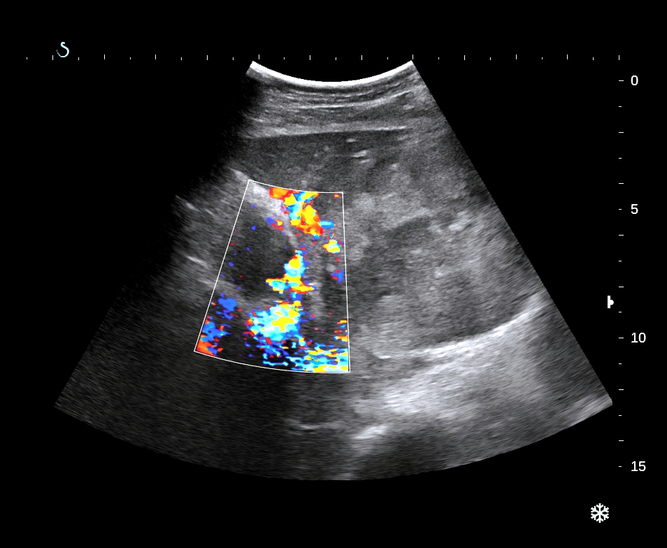 VIETNAMESE MEDIC ULTRASOUND: CASE 407: LIVER INFARCTION, Dr PHAN THANH ...