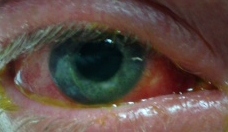 My Vision MD: Methamphetamines, Chemical Explosions, and Your Eyes