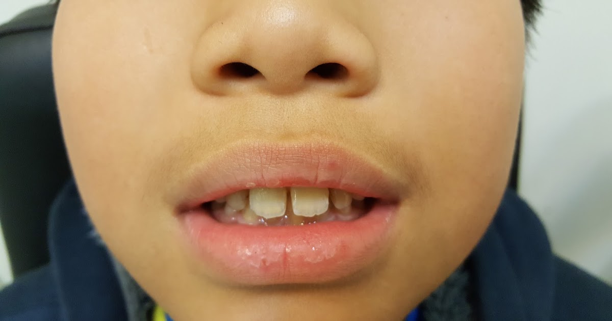 奇譽: 阿待臉 ADENOID FACE