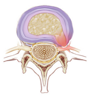 Q&A Time! Is it a Derangement or Motor Control/Stability Dysfunction ...