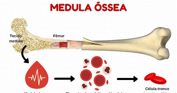 Mitos e verdades sobre o transplante de medula óssea