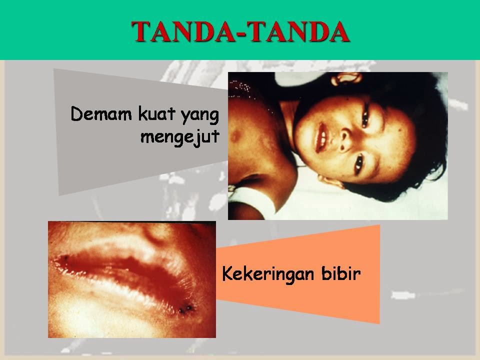 Selamat Datang ke SK Pekan Satu: DENGUE PATROL : TANDA-TANDA DEMAM DENGGI