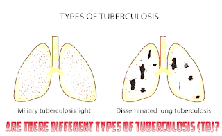 All about TB treatment & symptoms and causes TB (Tuberculosis (TB ...