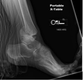 Case of the Month: Fracture cases at Harborview Medical Center ...
