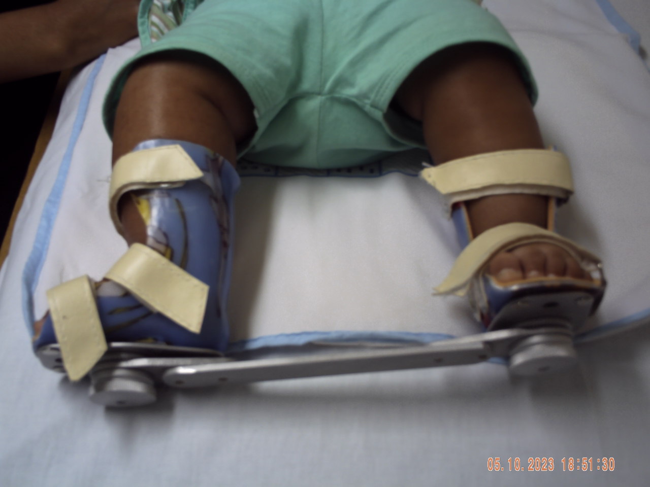 Amadurecendo Com Saúde: Pé torto congênito: Diagnóstico pré-natal e o ...