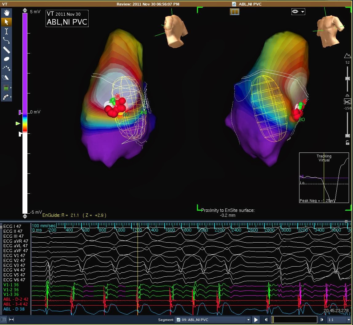 ardiana's: Ablasi pada Ventrikel Takikardi (Ventricular Tachycardi ...