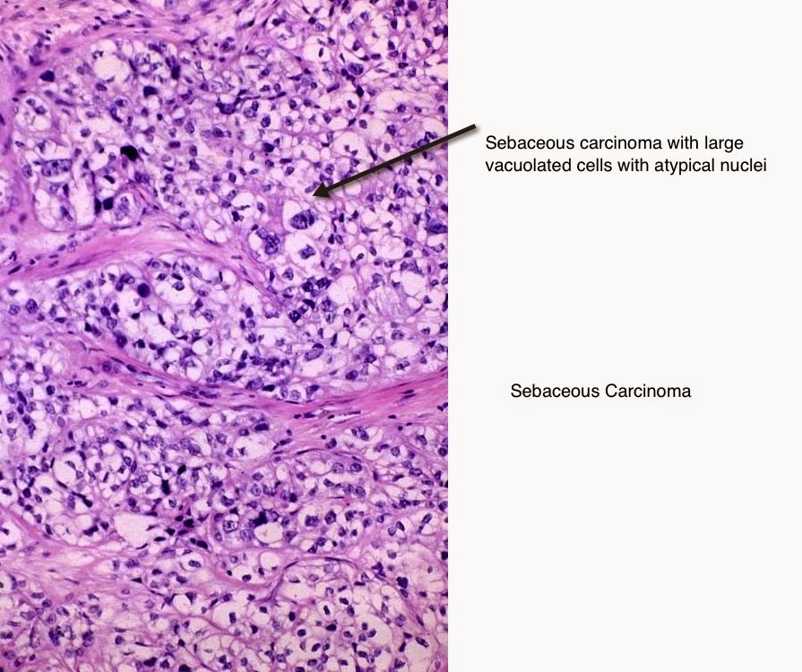 Dermpath Made Simple - Neoplastic: Sebaceous Tumours