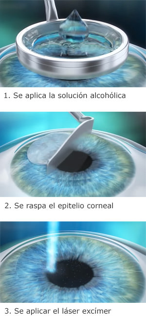 Técnicas Quirúrgicas : PRK/LASEK,UNAS TÉCNICAS INNOVADORAS